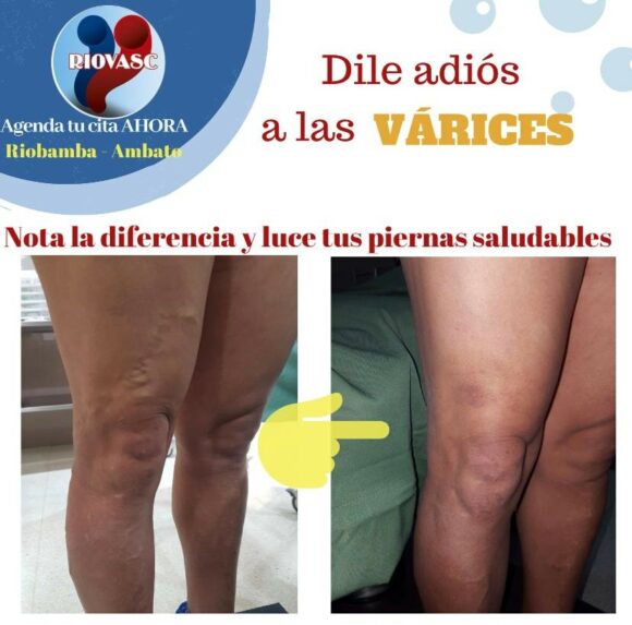 Varices Riobamba | Tratamiento Efectivo SIN DOLOR y al mejor precio.